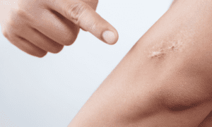 The Persistence of Internal Scar Tissue: Understanding Its Long-Term ...