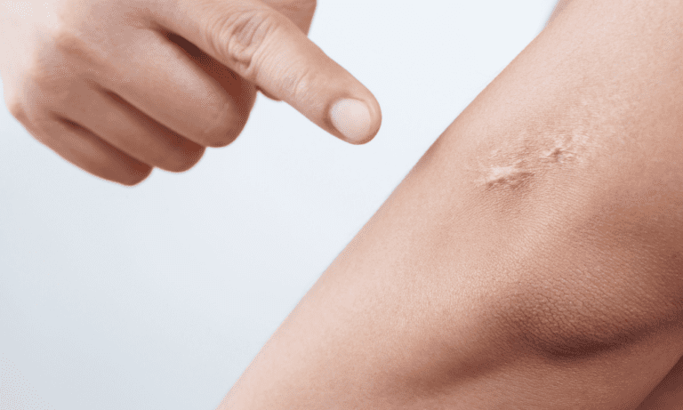 The Persistence of Internal Scar Tissue: Understanding Its Long-Term ...