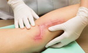 The Persistence of Internal Scar Tissue: Understanding Its Long-Term ...