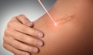 How to Naturally Dissolve Internal Scar Tissue | Apollo Soft Tissue and ...